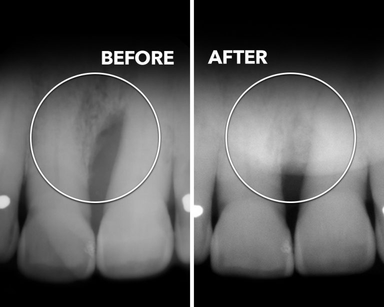 Dental Bone Graft Surgery | Poway Perio in San Diego